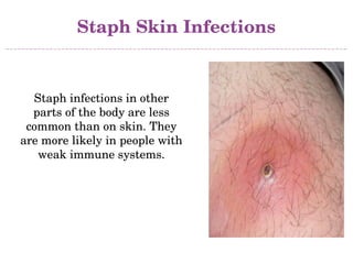 Prevent Staph Skin Infections | PPT