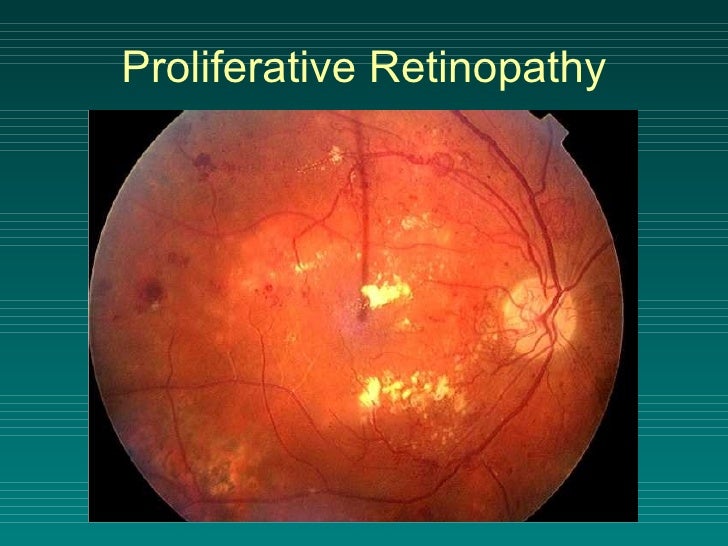 Nonproliferative Vs Proliferative Retinopathy