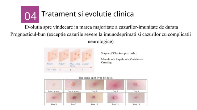 prezentare boli infectioase de caz clinic varicela .pptx