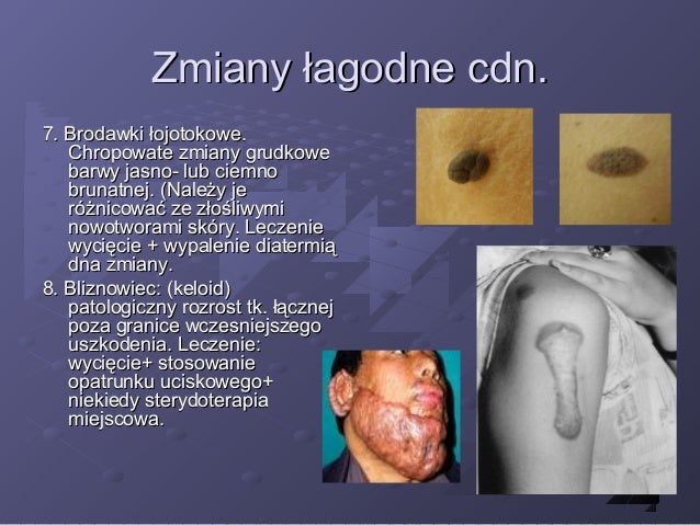 Prezentacja na temat raka skóry Prezentacja na temat raka skóry