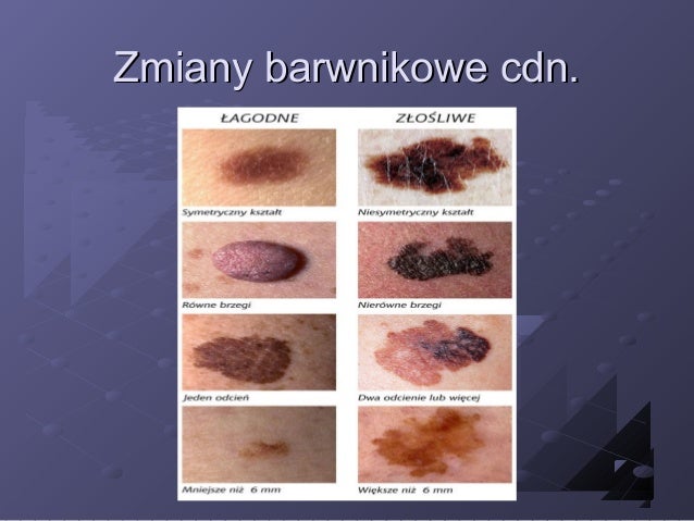 Prezentacja na temat raka skóry