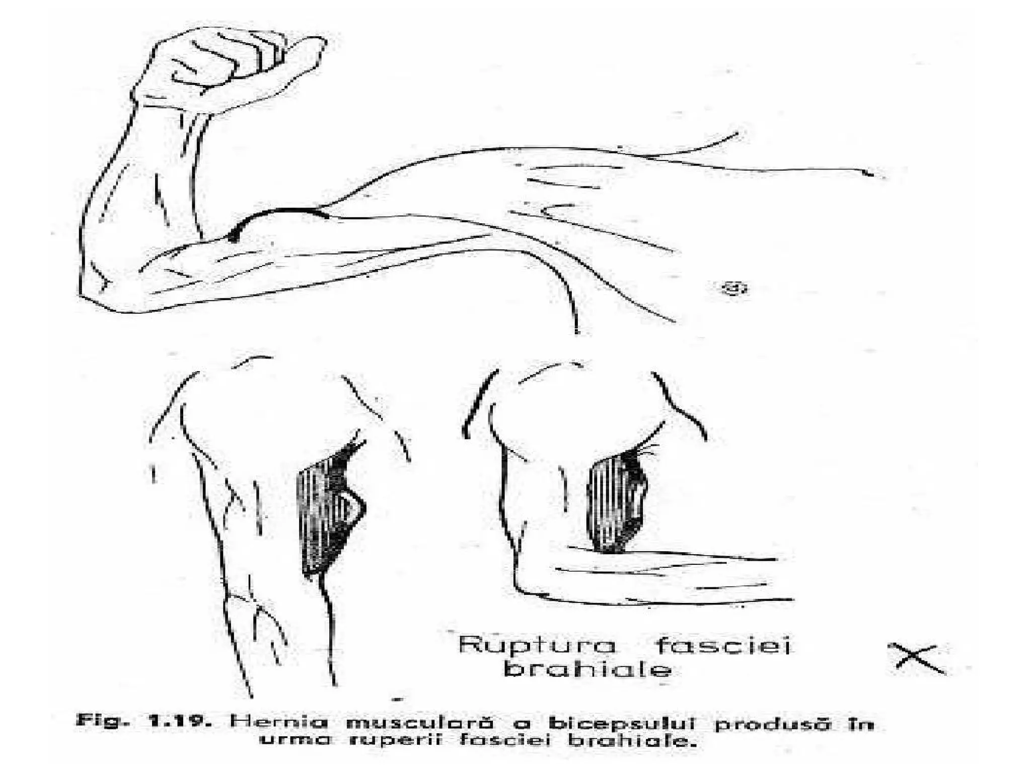 Prezentare chirurgie fracturi | PPT