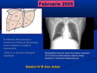 Prezentare limfom | PPT