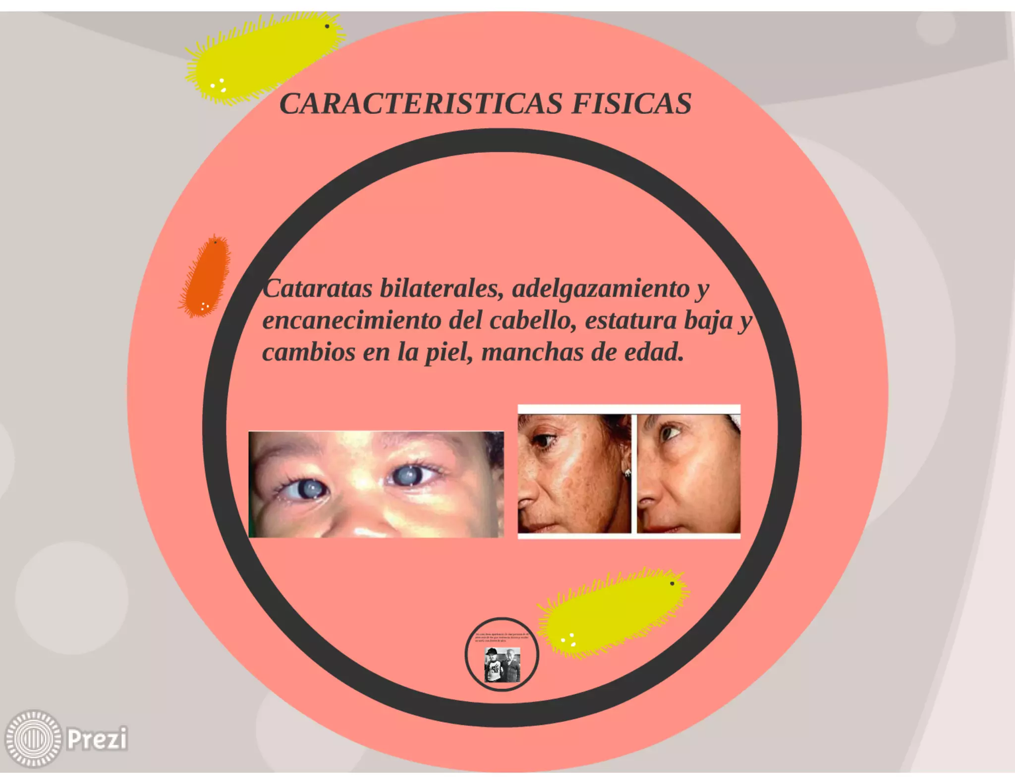 Prezi (sindrome de werner) | PDF