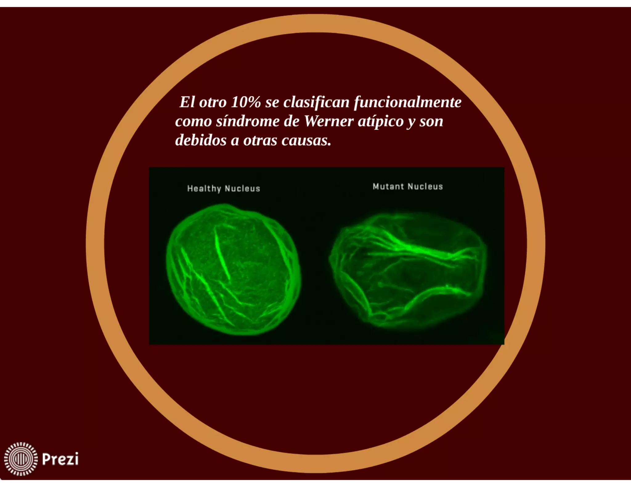 Prezi (sindrome de werner) | PDF