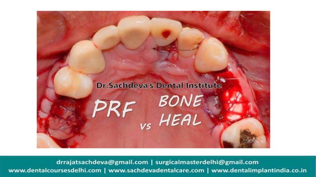 Platelet rich fibrin | Dental Implants with PRF | PRF In regenerative ...