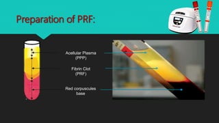 Platelet Rich Fibrin (PRF) in Dentistry | PPTX