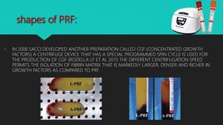 Platelet Rich Fibrin (PRF) in Dentistry | PPTX