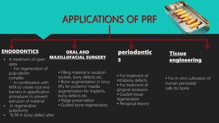 Platelet Rich Fibrin (PRF) in Dentistry | PPTX