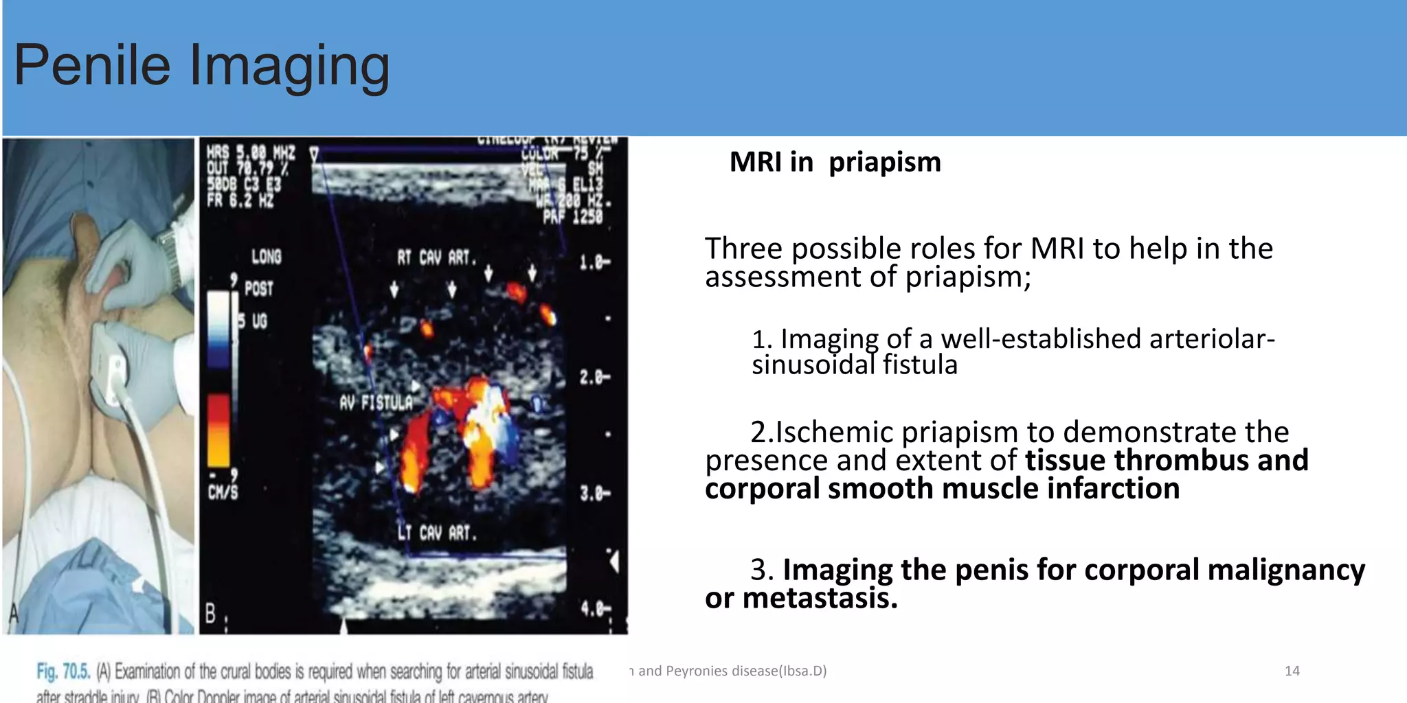 priapism and peyronies disease.pptx