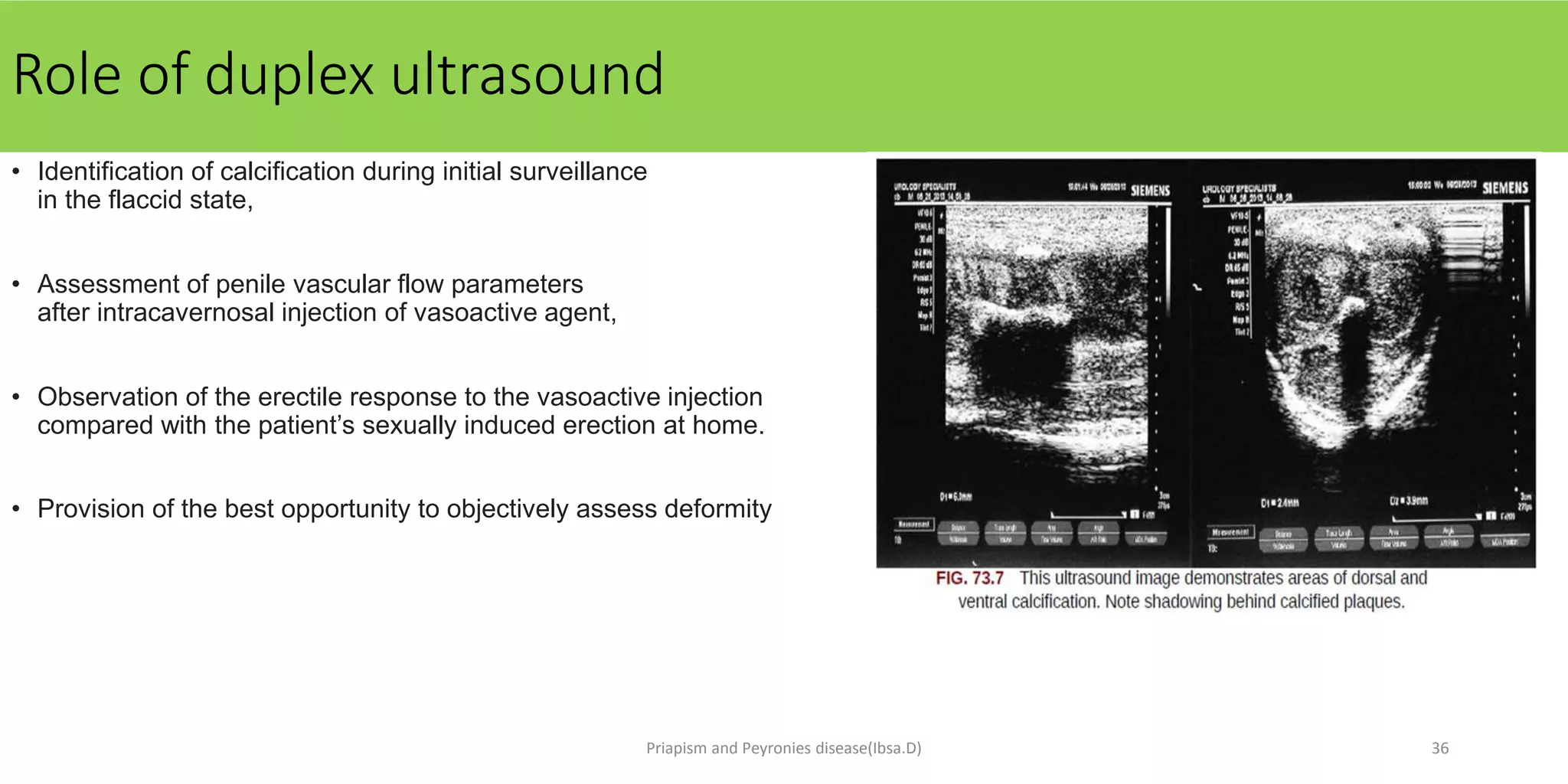 priapism and peyronies disease.pptx