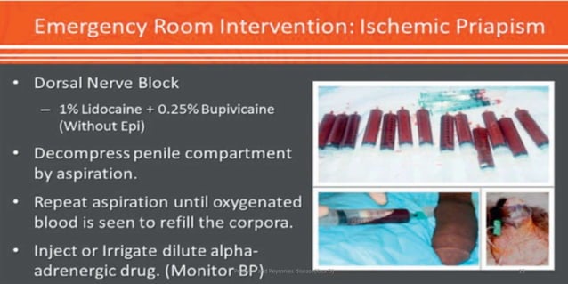priapism and peyronies disease.pptx