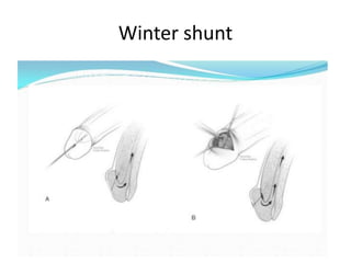 Priapism 2015 | PPTX