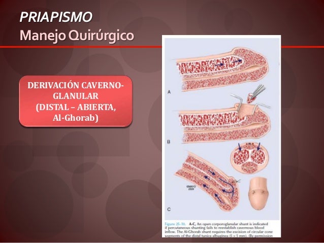 Manejo del Priapismo