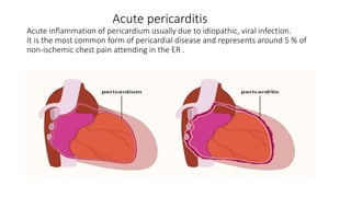 pericardial disease | PPTX