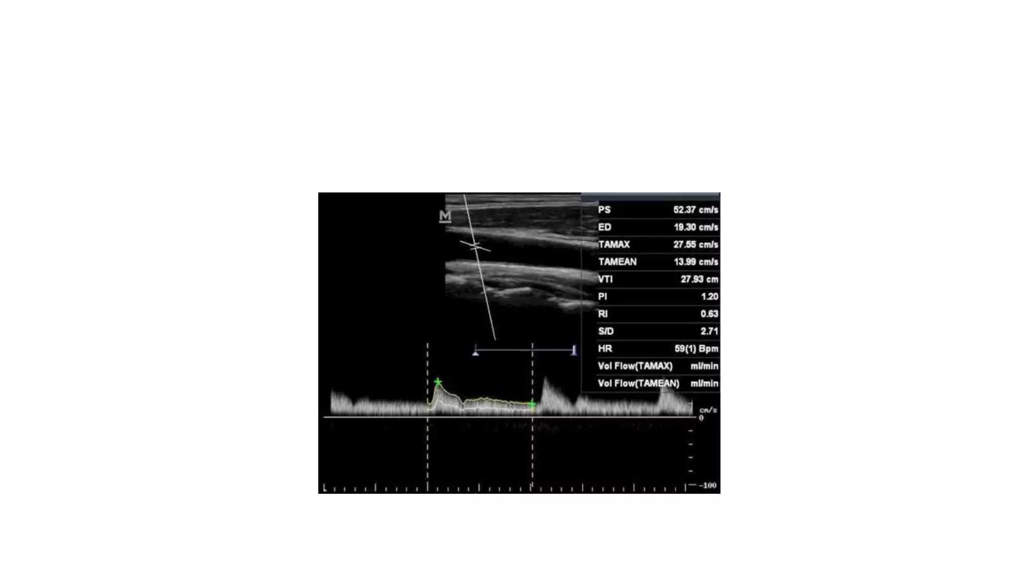 Principle of iv fluid in septic shock | PPTX