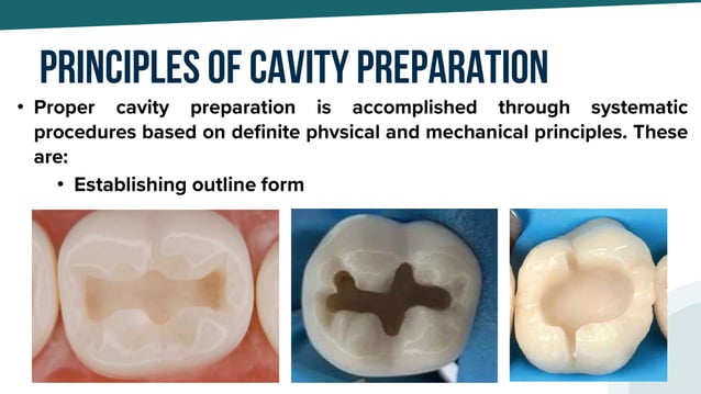 principles of cavity preparation... pptx | PPTX