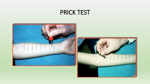 Prick test
