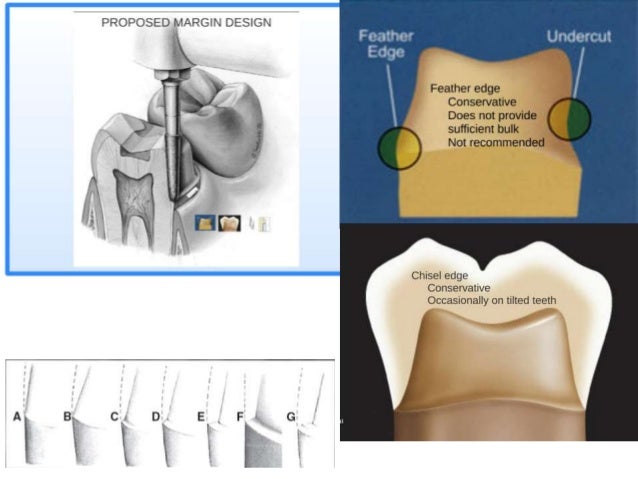 Prienciple of tooth prepration
