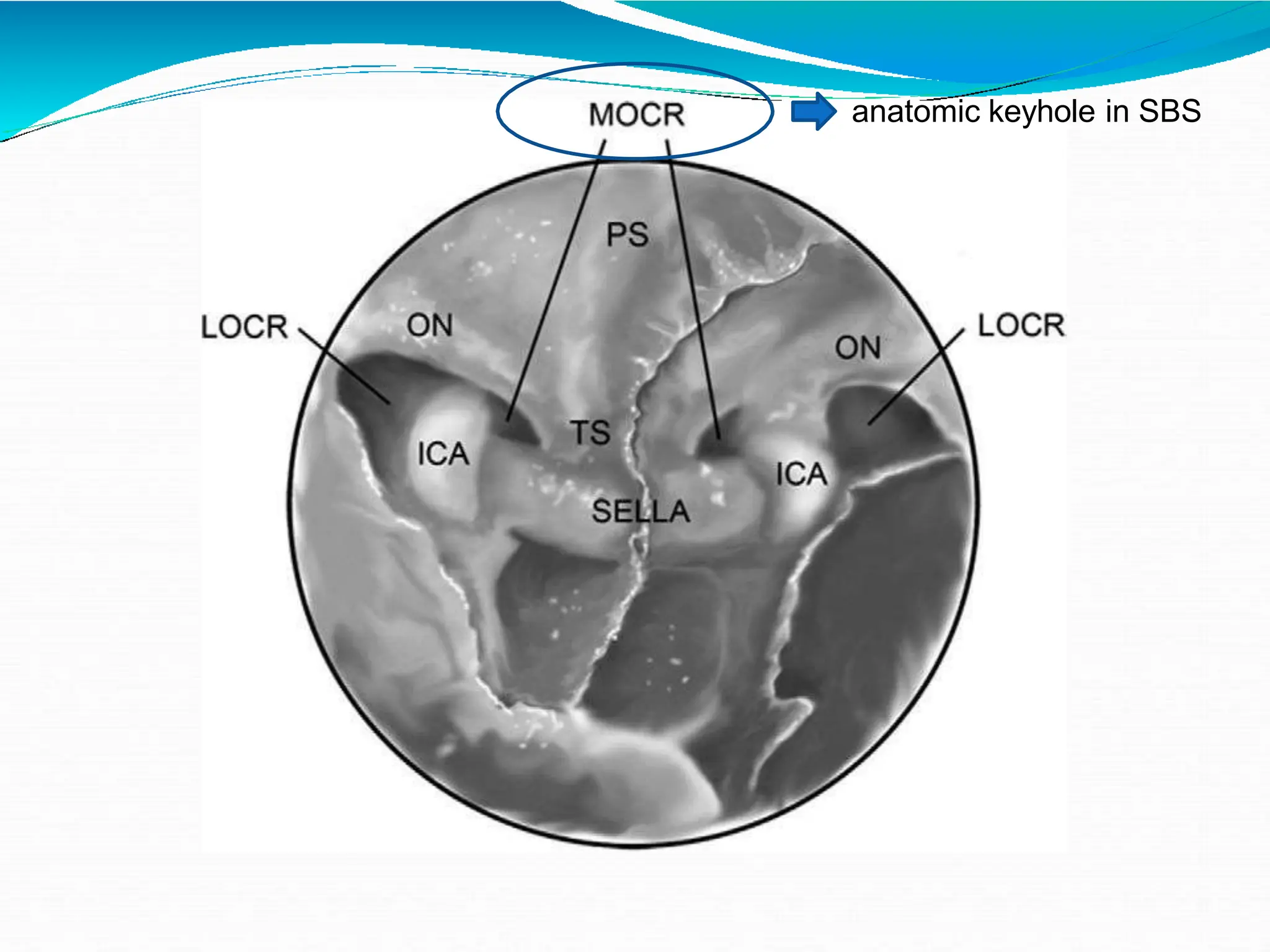 primary-sinus-surgery_compress.pptx