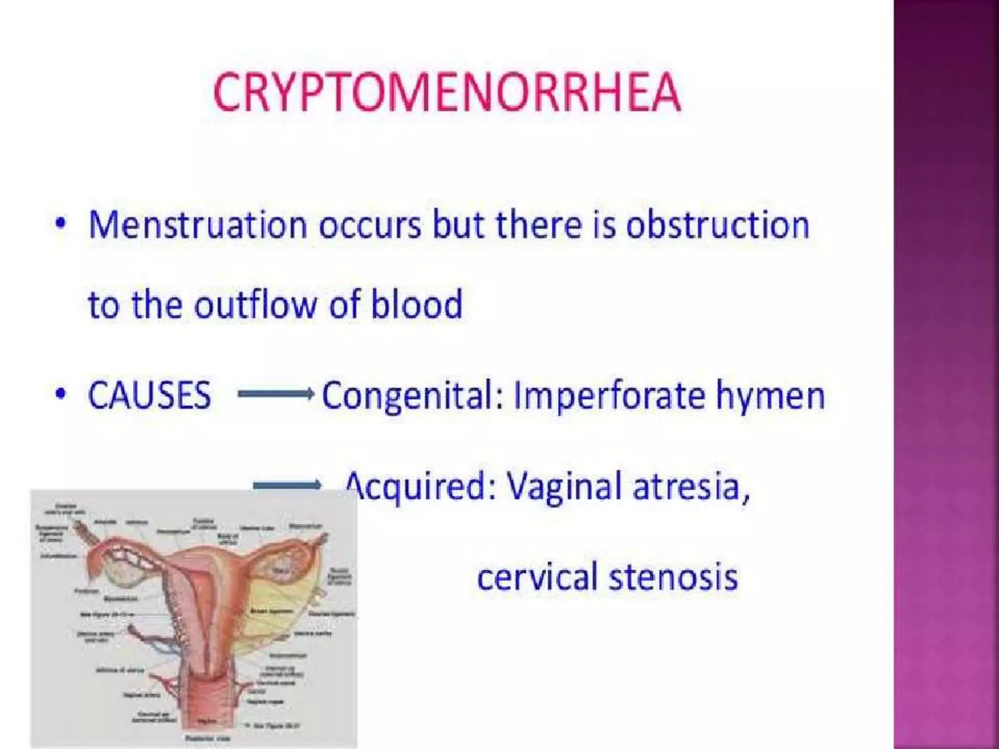 Primary amenorrhea and management | PPTX