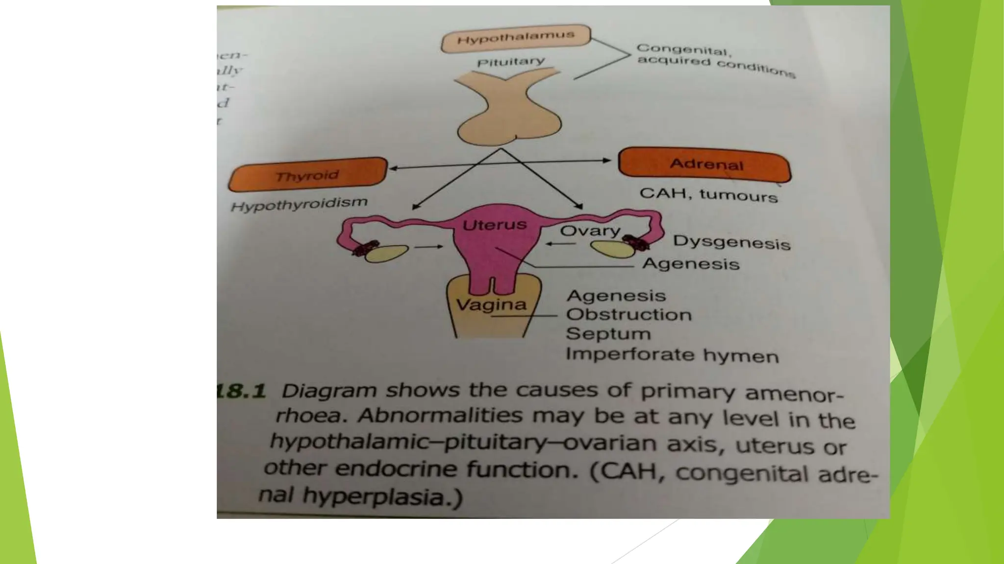 PRIMARY AMENORRHOEA obg presentatiom.pptx