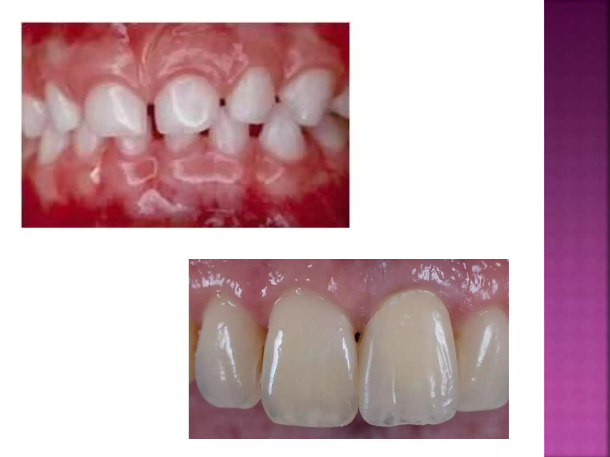 Difference between Primary and permanent teeth | PPTX