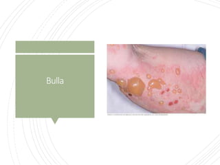 Primary and secondary lesions ( oral medicine) | PPTX