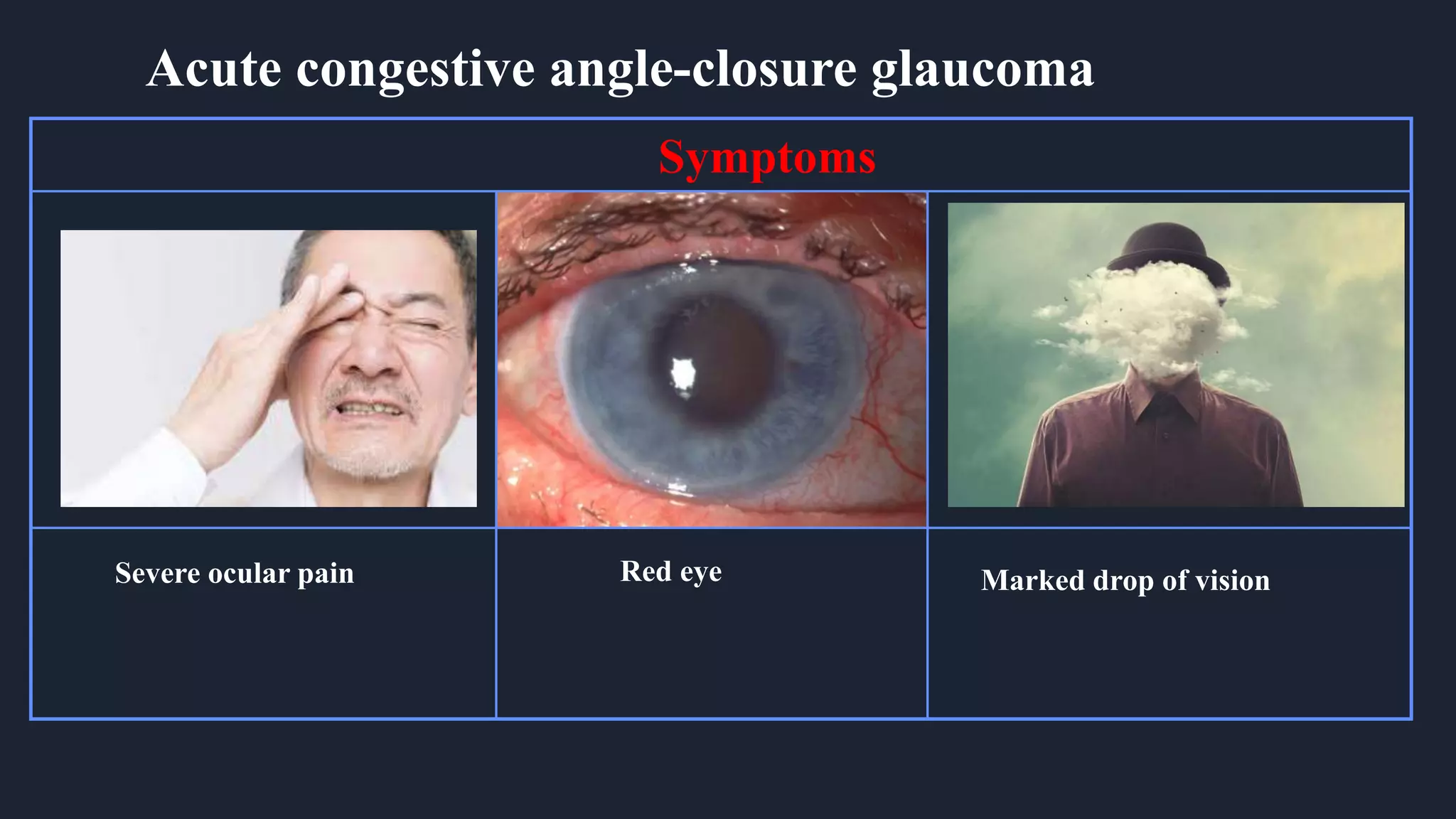 Primary angle closure glaucoma | PPTX