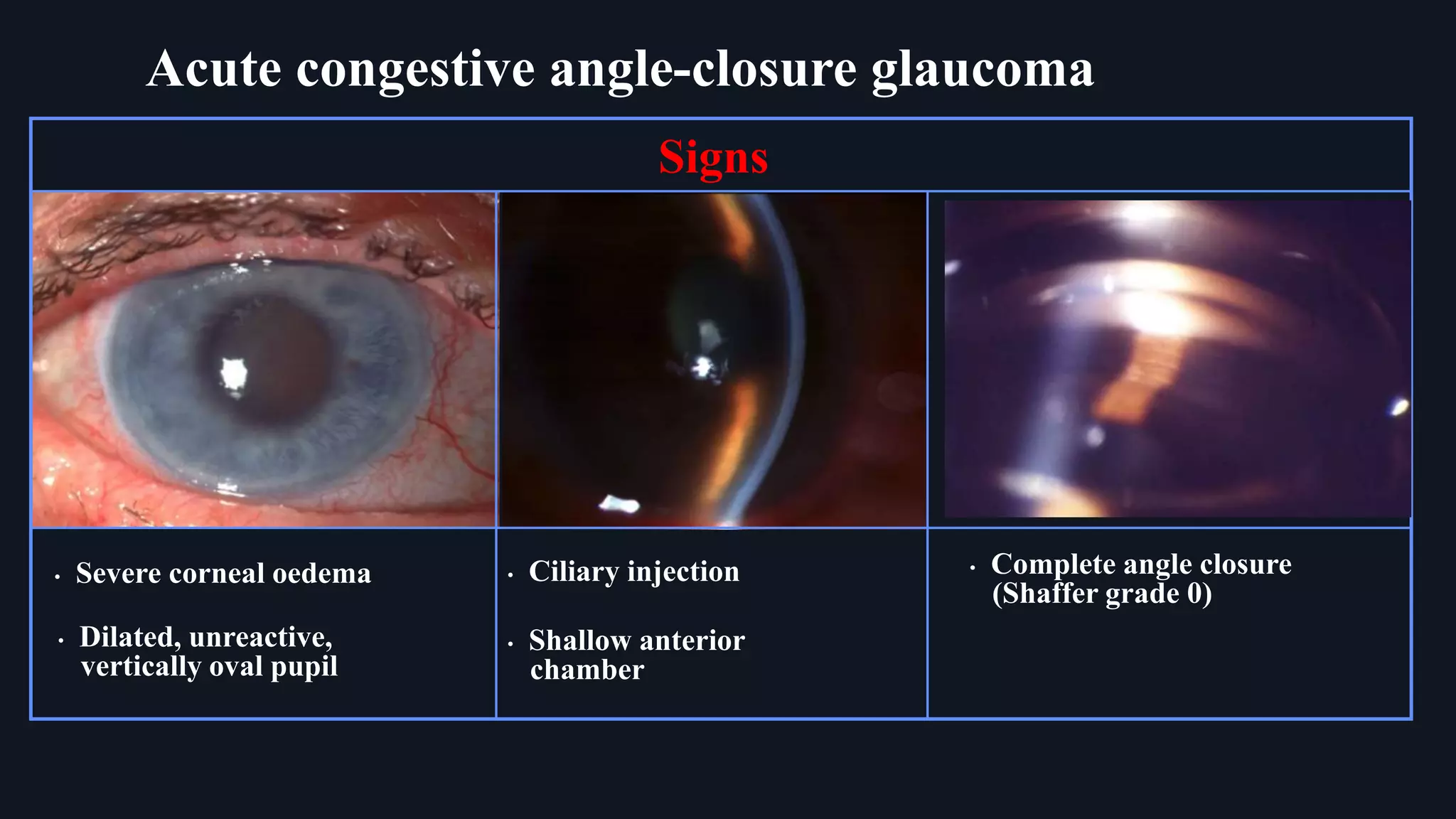 Primary angle closure glaucoma | PPTX