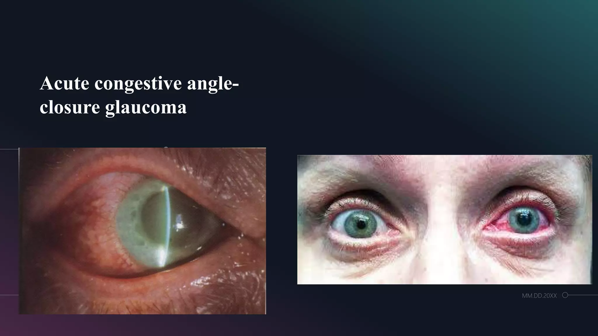 Primary angle closure glaucoma | PPTX