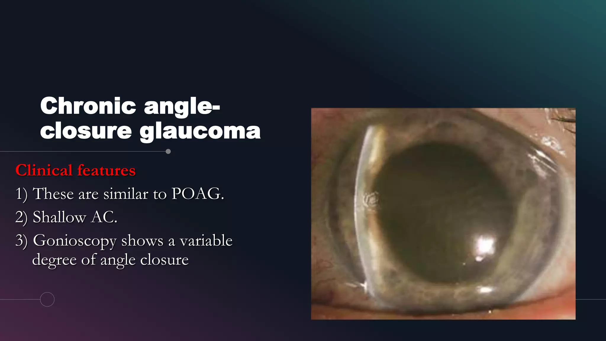 Primary angle closure glaucoma | PPTX