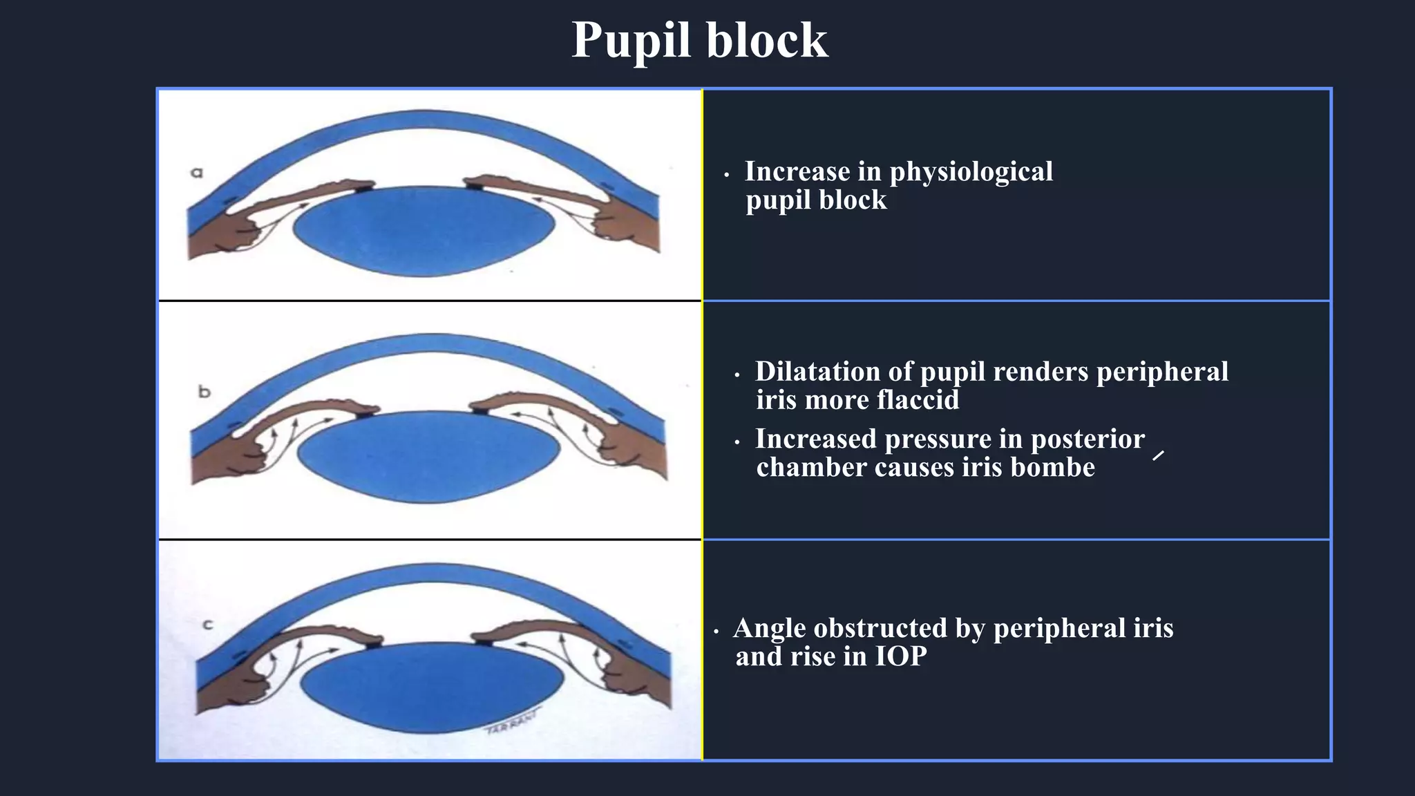 Primary angle closure glaucoma | PPTX