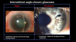 Primary angle closure glaucoma | PPTX