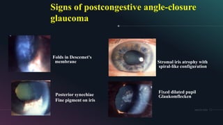 Primary angle closure glaucoma | PPTX
