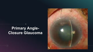 Primary angle closure glaucoma | PPTX