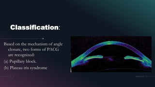 Primary angle closure glaucoma | PPTX