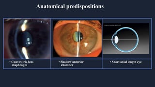Primary angle closure glaucoma | PPTX