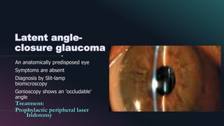 Primary angle closure glaucoma | PPTX