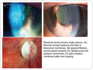 Acute Angle Closure Glaucoma Fundoscopy