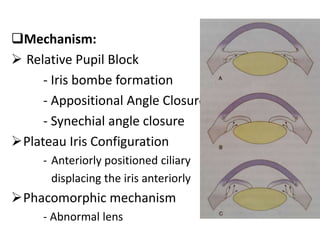 Primary Angle Closure Glaucoma- Saral | PPT
