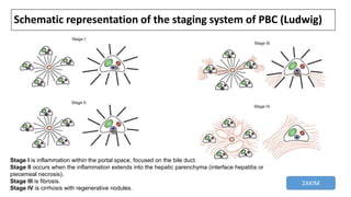 Primary Biliary Cholangitis | PPTX