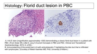 Primary Biliary Cholangitis | PPT
