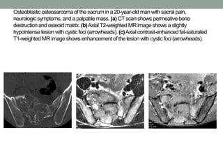 Primary bone tumors of the spine | PPTX