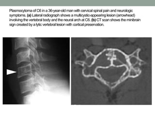 Primary bone tumors of the spine | PPTX
