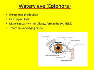 Primary care ophthalmology teaching | PPTX