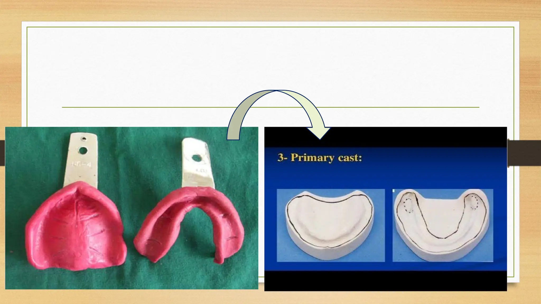 primary cast & special tray in complete dentures.pptx
