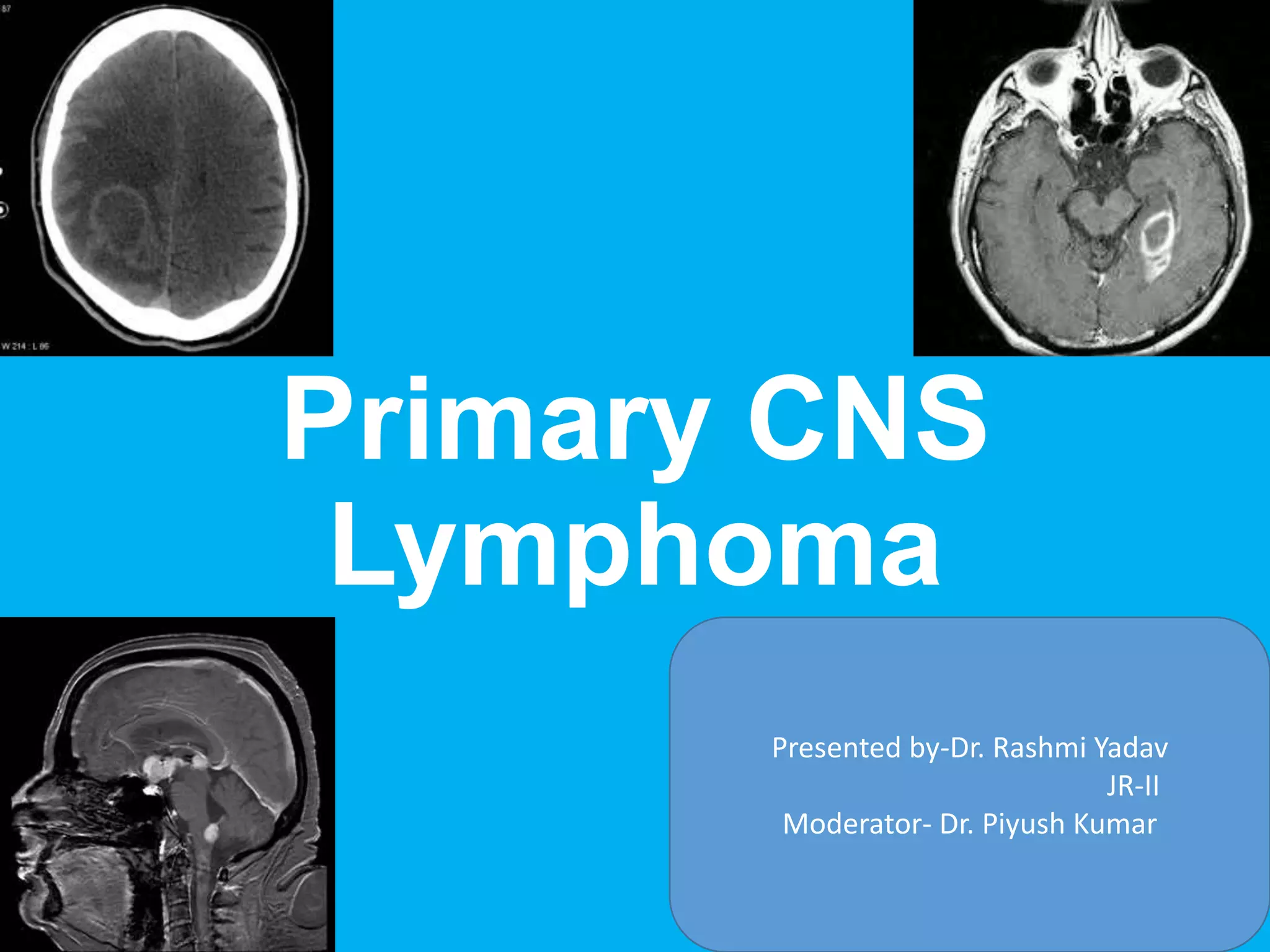 Primary CNS Lymphoma | PPTX