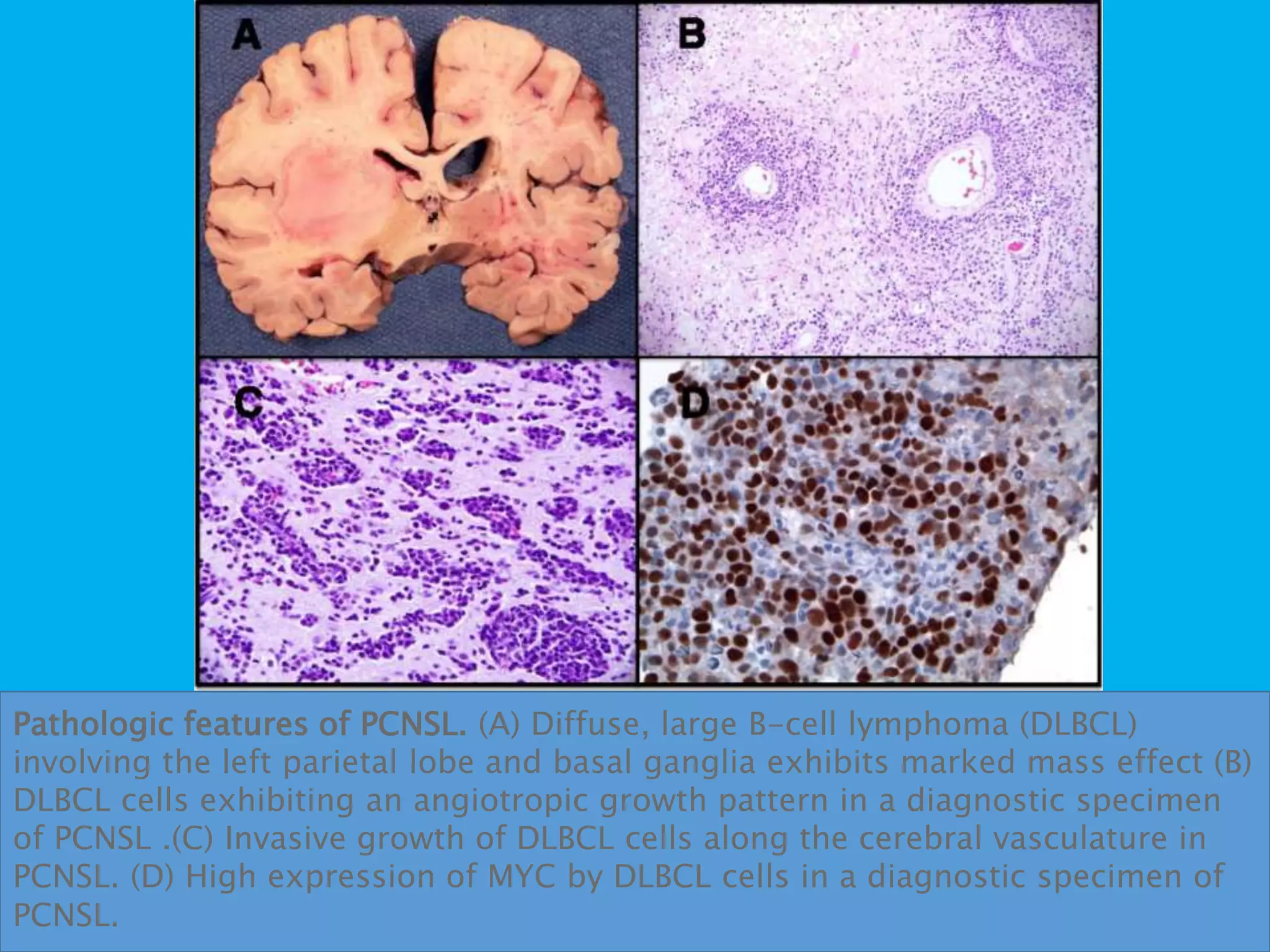 Primary CNS Lymphoma | PPTX
