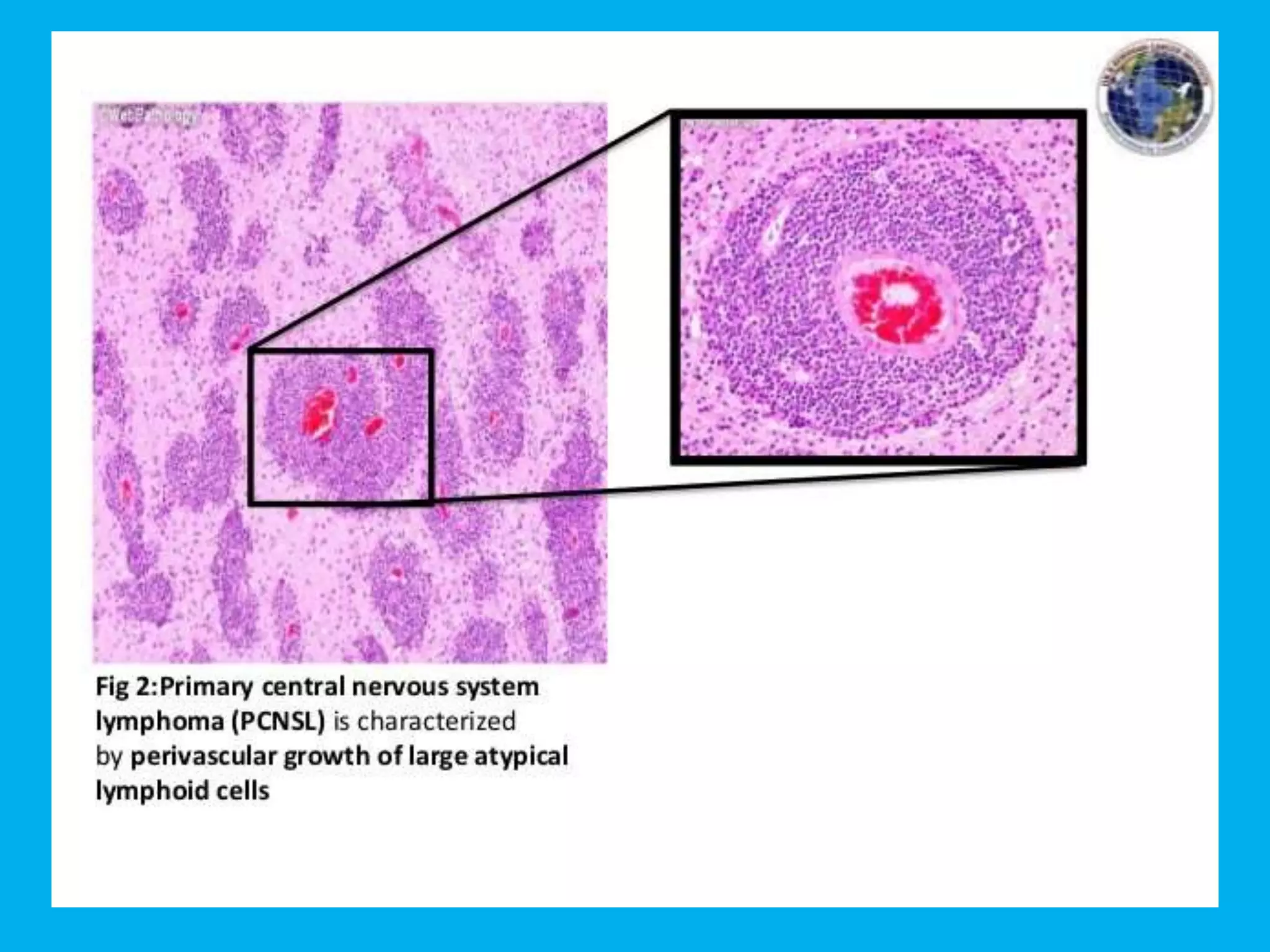Primary CNS Lymphoma | PPTX